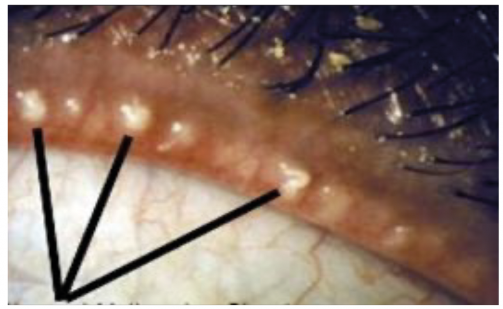 Rosácea dérmica y ocular desde un punto de vista clínico y descriptivo ...
