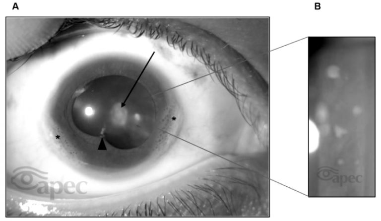 Pars planitis: una patología ocular que debe informarse – Ciencia UANL
