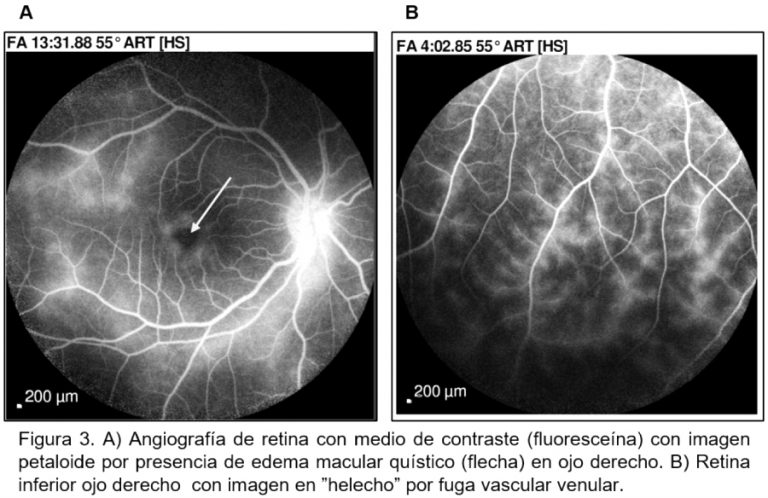 Pars planitis: una patología ocular que debe informarse – Ciencia UANL
